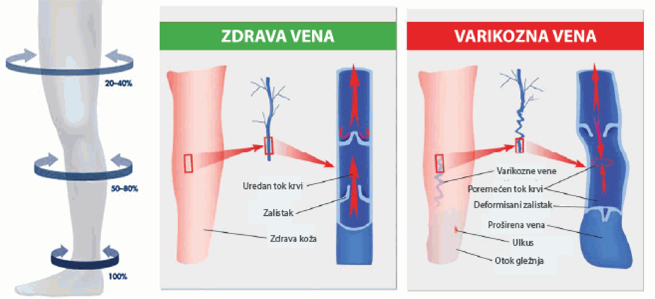 Čarape za vene Nadkolena čarapa MEDICALE SOFT CLASS 2 AGH (23-32 mmHg ...
